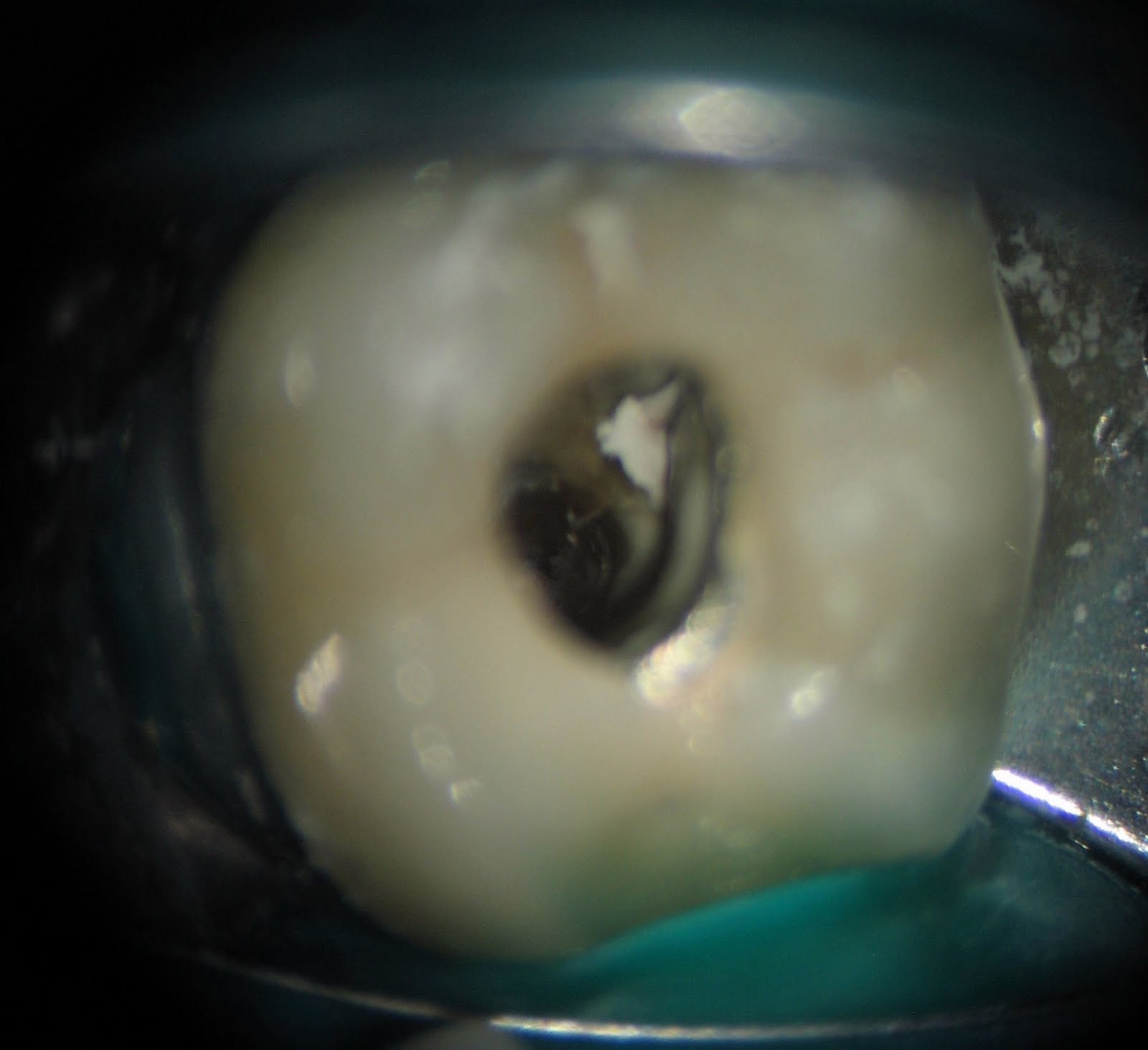 Clinical Clues for Identifying Cracked/Fracture Roots