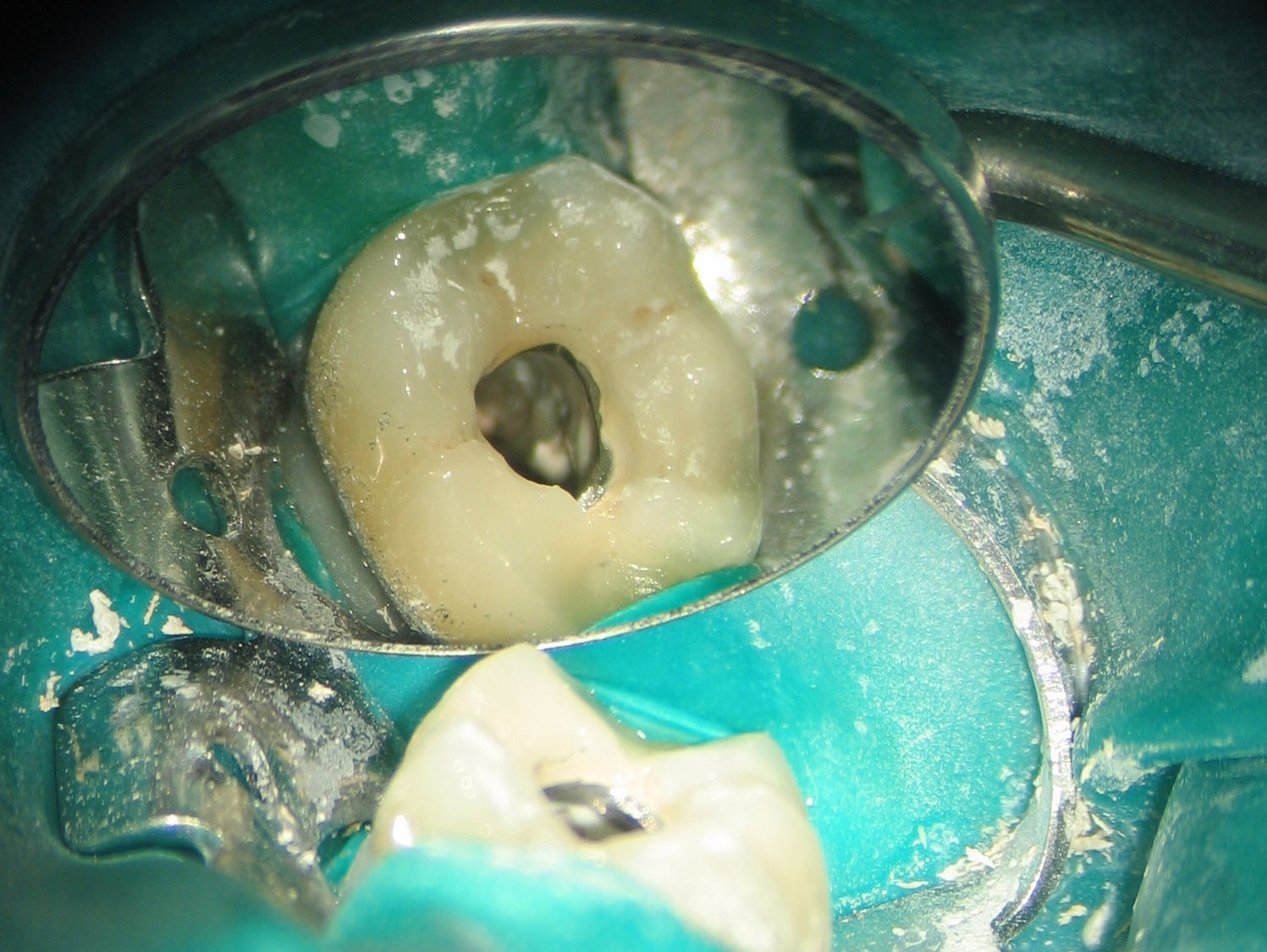 BDS INSIGHTS: Clinical Clues for Identifying Cracked/Fracture Roots