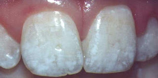 What is DENTAL FLUOROSIS