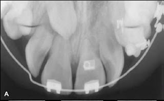 Aula Virtual Ortodoncia 3: Reabsorcion Radicular