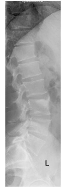 RHB and Physical Medicine: Clinical Aspects of Ankylosing Spondylitis
