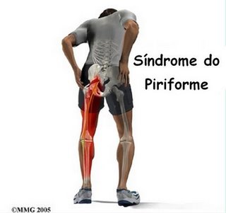 Fisioterapia Quintana: O QUE É SÍNDROME DO PIRIFORME?
