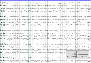 Miniature Stump: Electroencephalogram, Defined