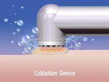 How Does Coblation Work? | Fauquier ENT Blog