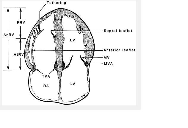 cardiology: ABNORMALITIES OF RIGHT VENTRICULAR INFLOW