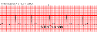 applePie's Corner: ECG made easy...My version-02(for emergency setting)