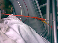 Docencia en Enfermeria: INSTALACIÓN DE SONDA SENGSTAKEN/BLAKEMORE