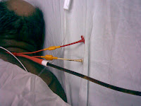 Docencia en Enfermeria: INSTALACIÓN DE SONDA SENGSTAKEN/BLAKEMORE