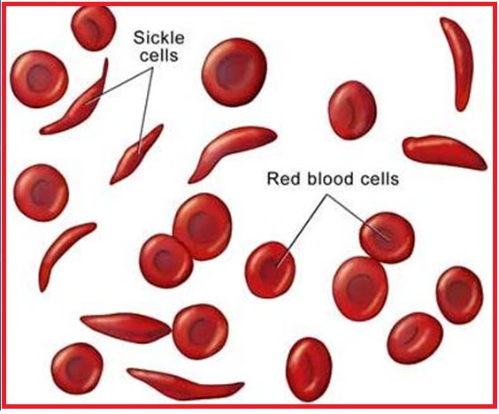 BIOLOGI GONZAGA: SICKLEMIA