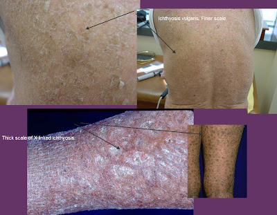 Differential Diagnosis in Dermatology: Skin coloured scaly diseases