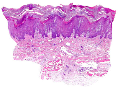 Teaching Dermatopathology: 9. Epidermal Patterns- Psoriasiform