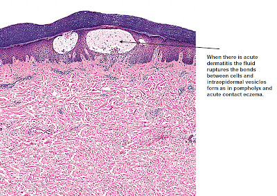 Teaching Dermatopathology: 10. Epidermal Patterns- Spongiotic