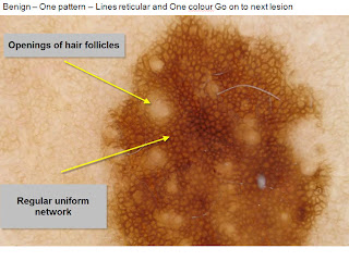 Differential Diagnosis in Dermoscopy / Dermatoscopy