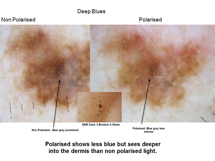Dermoscopy Made Simple: Which dermatoscope should I buy? and Using my ...