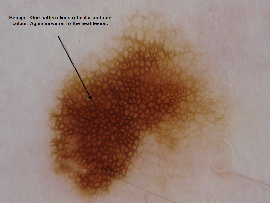 Dermoscopy Made Simple: Introduction.