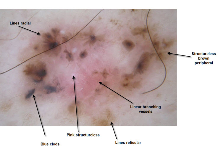 Dermatoscopy Made Simple