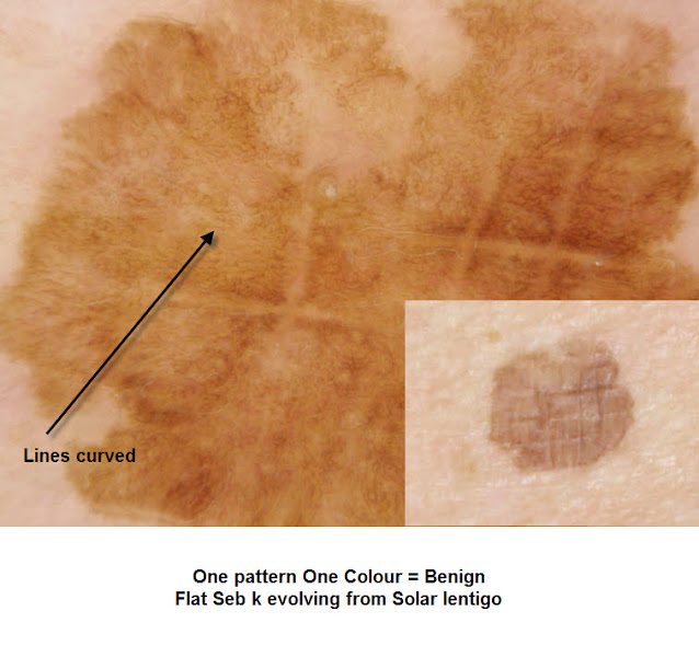 Dermoscopy Features as Clues: Lines Curved