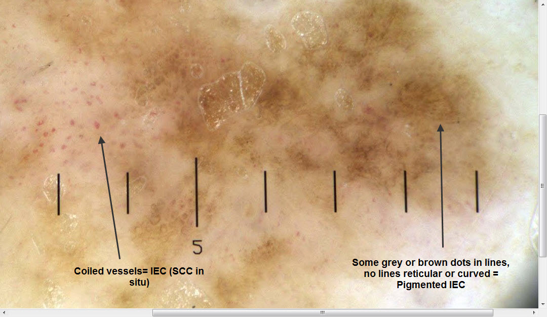 Dermoscopy Made Simple: Great Blog Cases