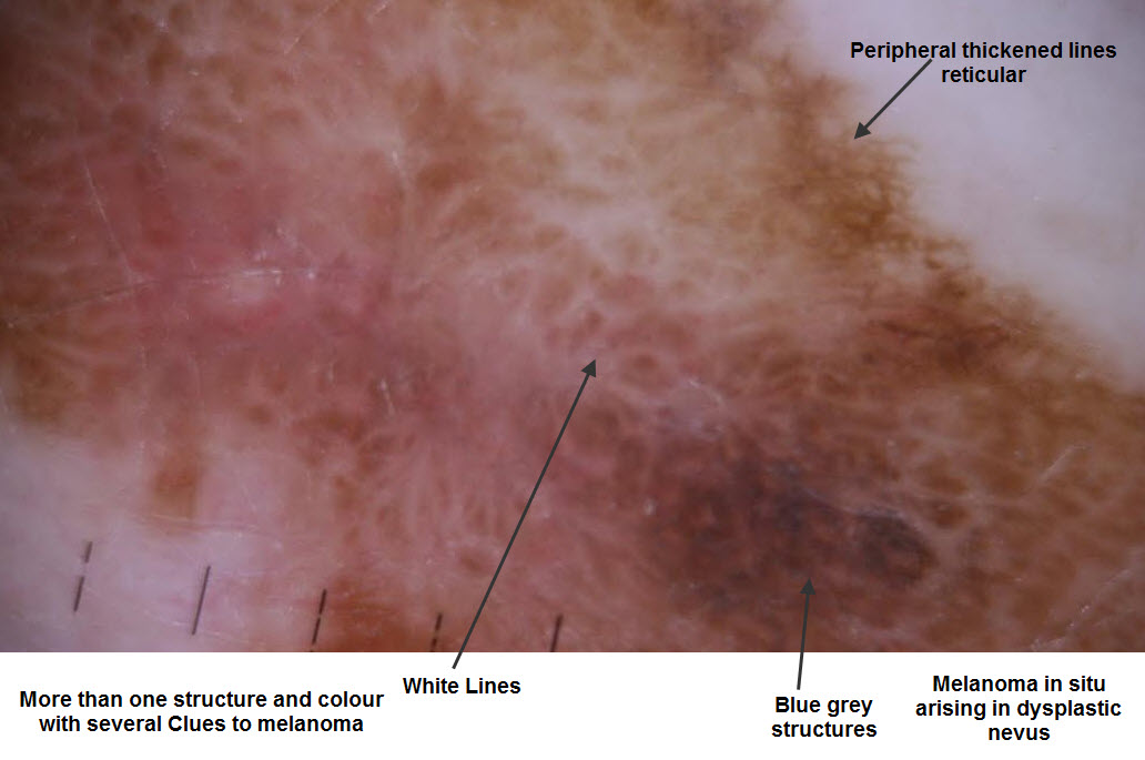 Dermoscopy Made Simple: Clues to Melanoma