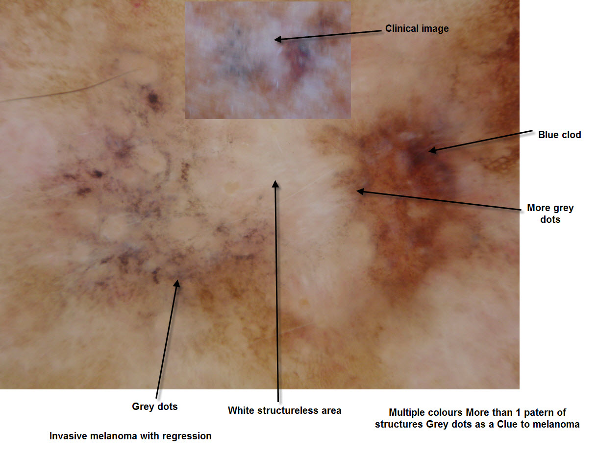 Dermoscopy Made Simple: Clues to Melanoma