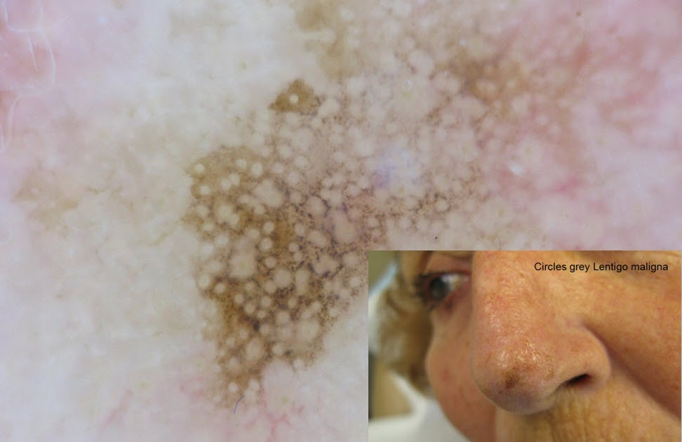 Dermoscopy Features as Clues: Grey or Black Circles