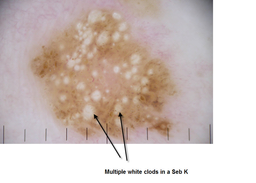 Dermoscopy Made Simple: Clods