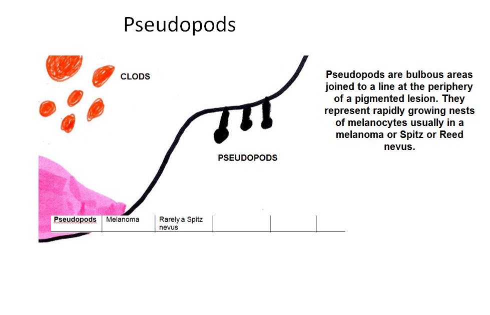 Dermatoscopy Made Simple: Pseudopods