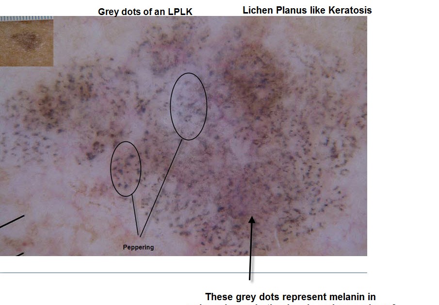 Dermoscopy Features as Clues: Dots Grey