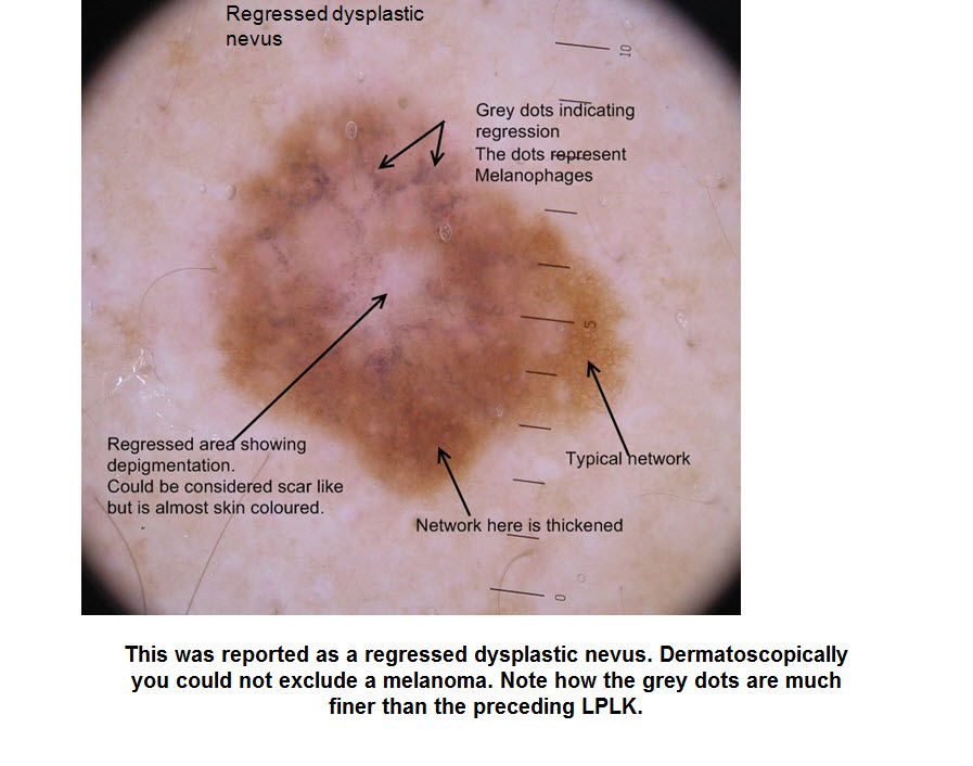 Dermoscopy Made Simple: Dots