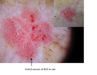 Dermoscopy Made Simple: Vessels