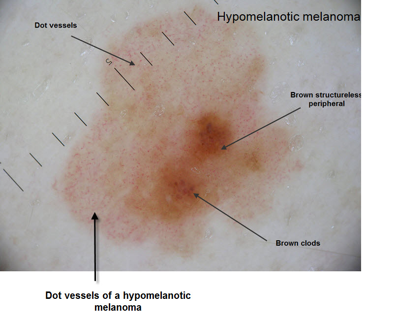 Dermoscopy Made Simple: Vessels