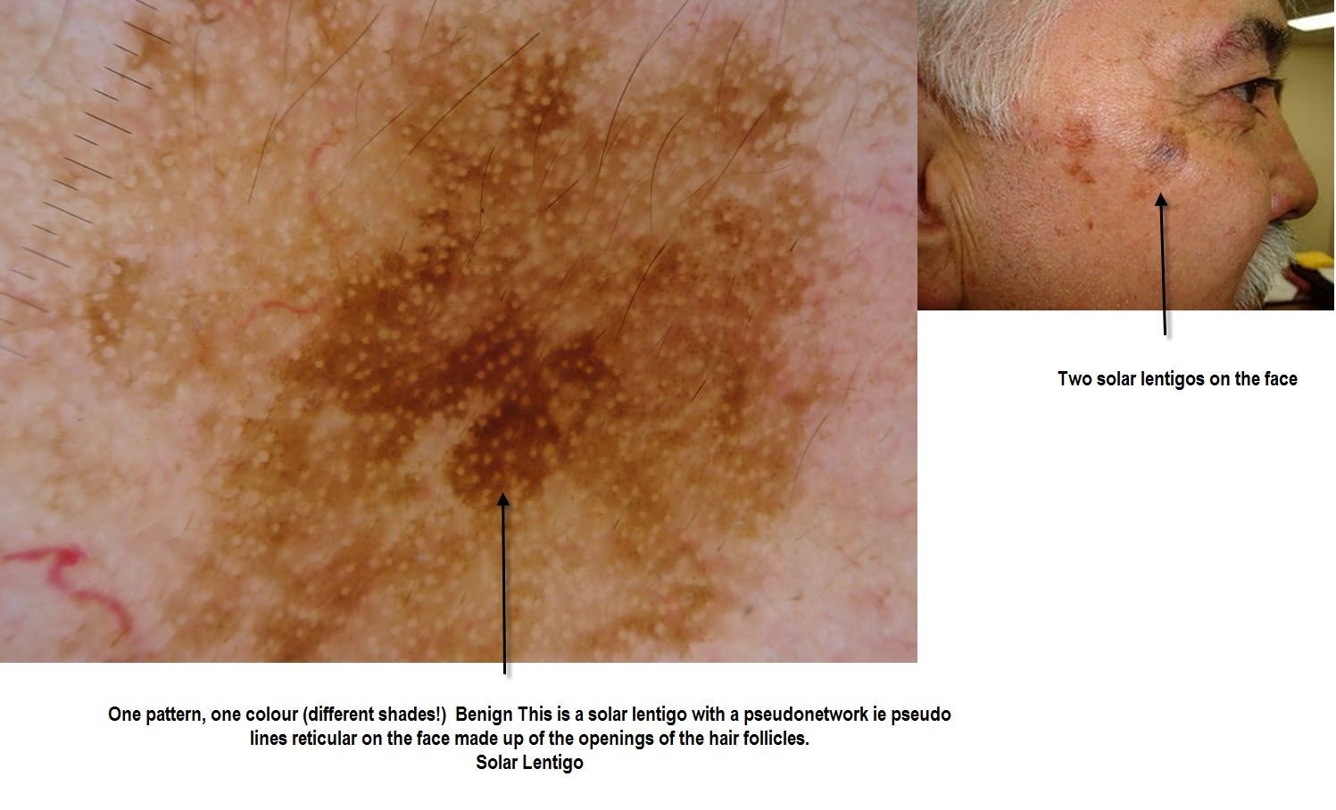 Dermoscopy Made Simple: Lines