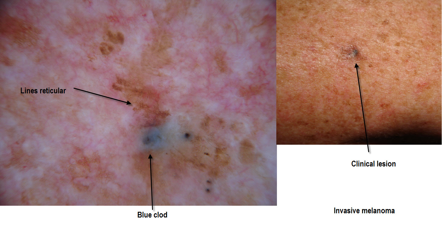 Dermatoscopy Made Simple: Clods