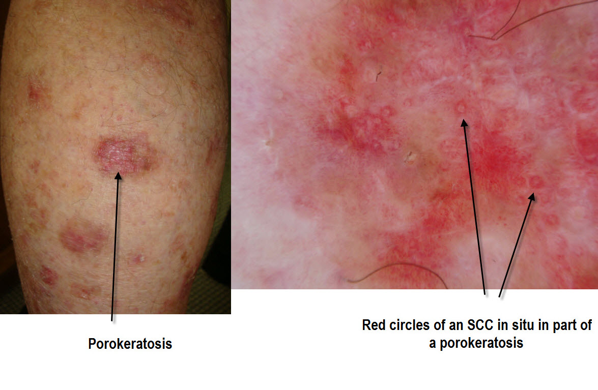 Dermoscopy Made Simple: SCC in Situ and Pigmented Bowen's