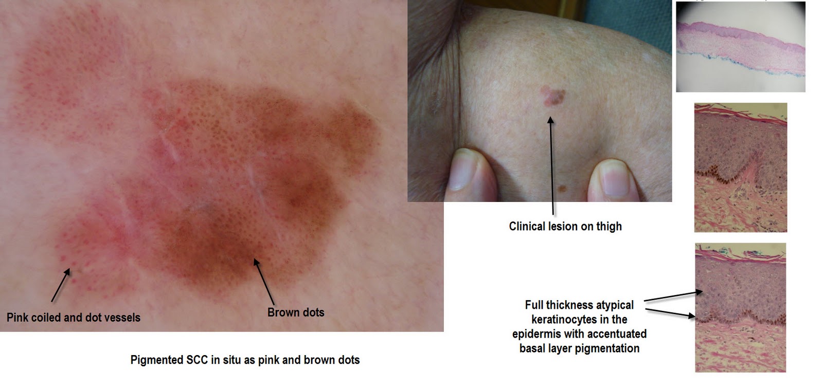 Dermoscopy Made Simple: SCC in Situ and Pigmented Bowen's