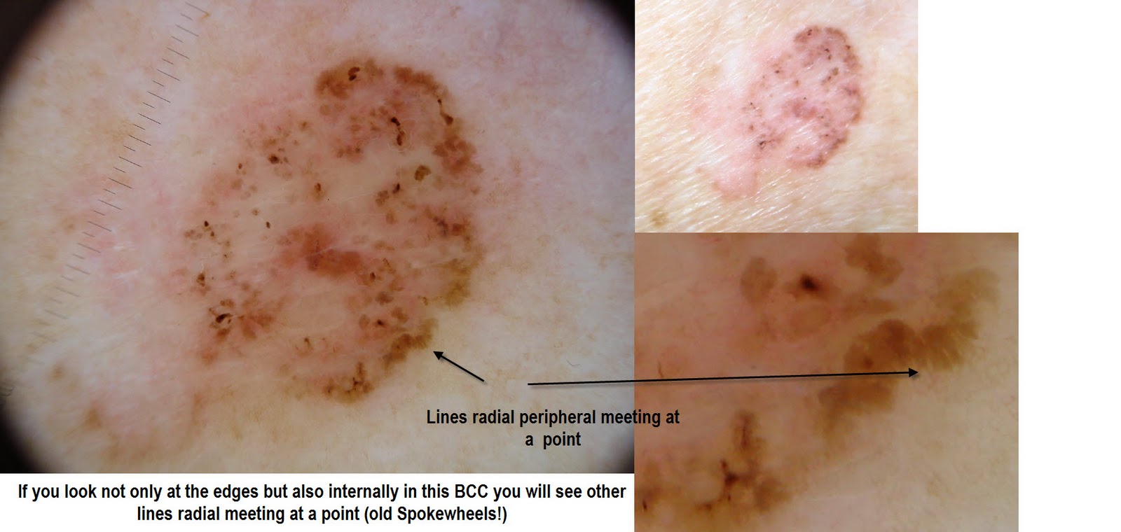 Dermoscopy Made Simple: Basal Cell Carcinoma