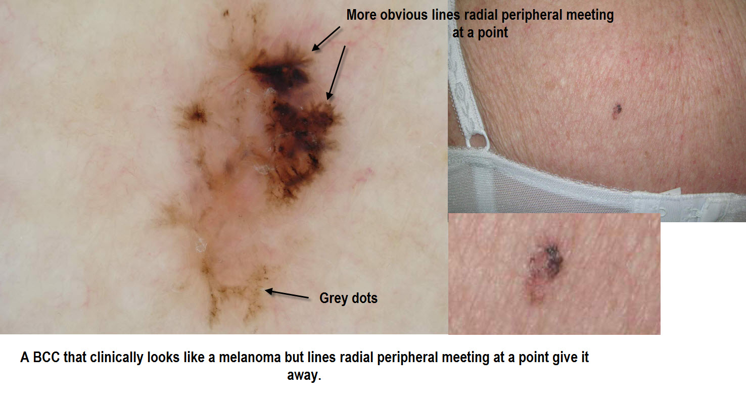 Dermoscopy Made Simple: Basal Cell Carcinoma