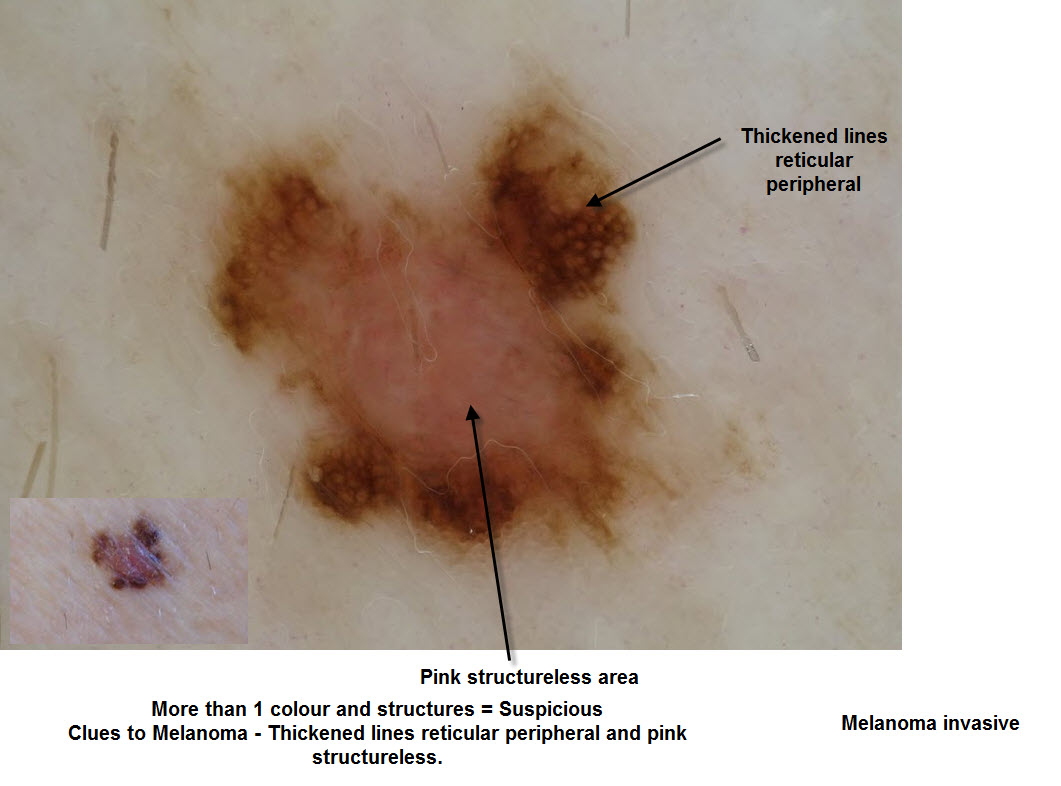 Dermoscopy Made Simple: Clues to Melanoma