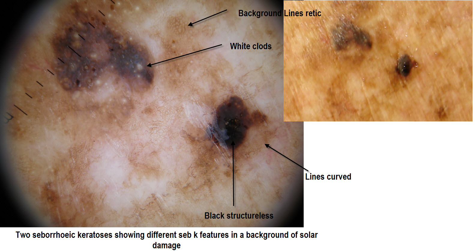 Dermoscopy Made Simple: Seborrhoeic Keratoses