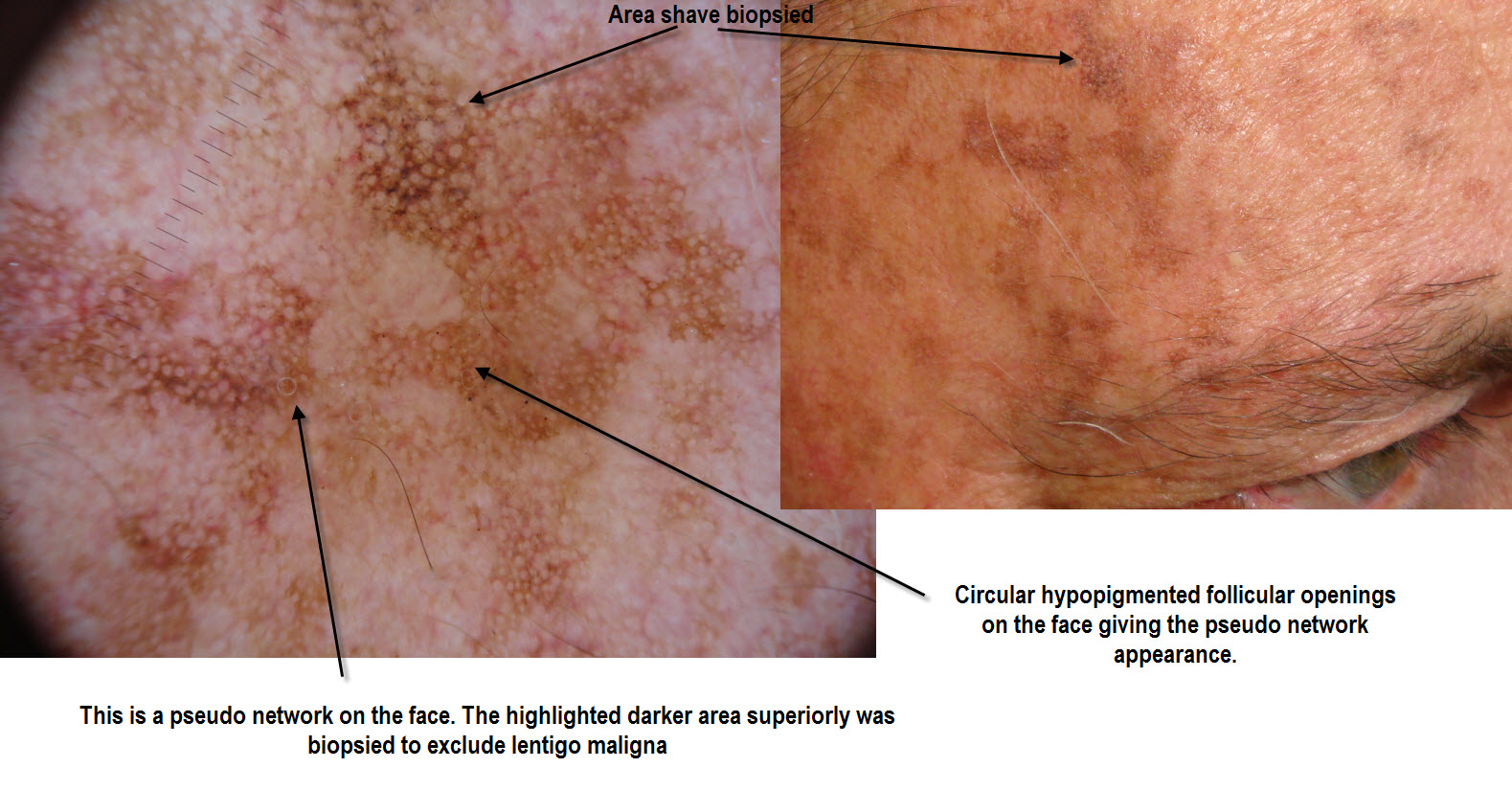 Dermoscopy Made Simple: Solar Lentigo