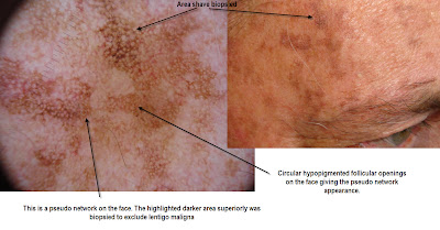 Dermoscopy Made Simple: Solar Lentigo
