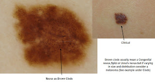 Dermoscopy Made Simple: Benign Nevus