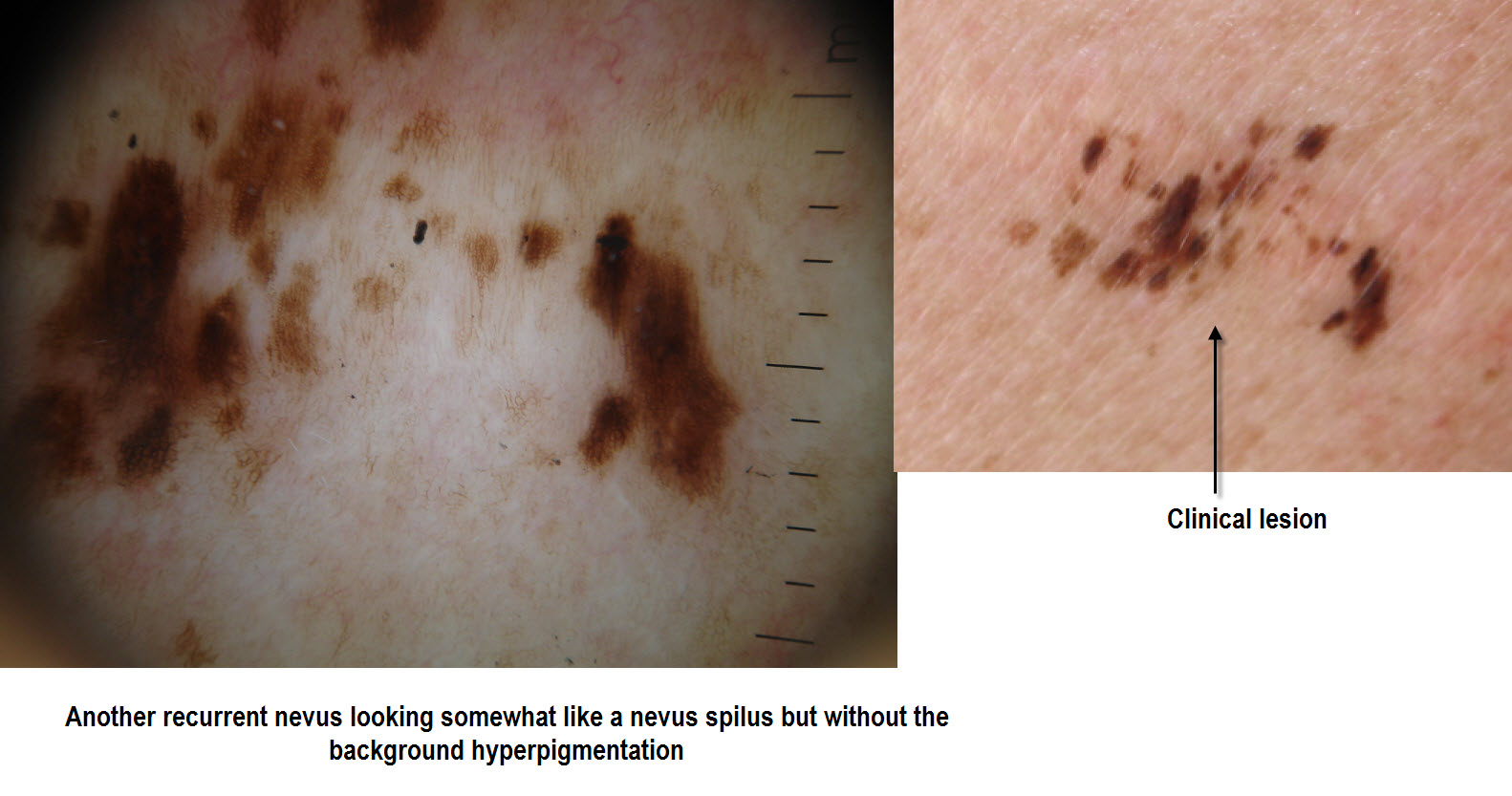 Dermoscopy Made Simple: Benign Nevus