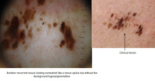 Dermoscopy Made Simple: Benign Nevus