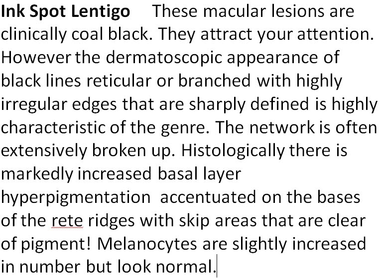 Dermoscopy Made Simple: Ink Spot Lentigo