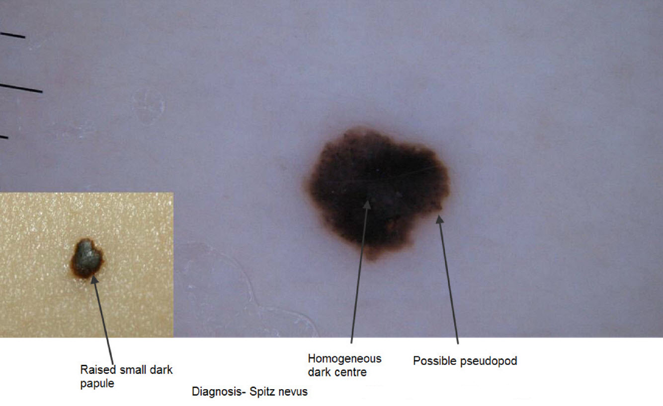 Dermoscopy Made Simple: Spitz Nevus