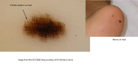 Dermoscopy Made Simple: Acral nevus