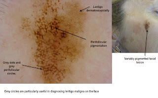 Dermoscopy Made Simple: Lentigo maligna