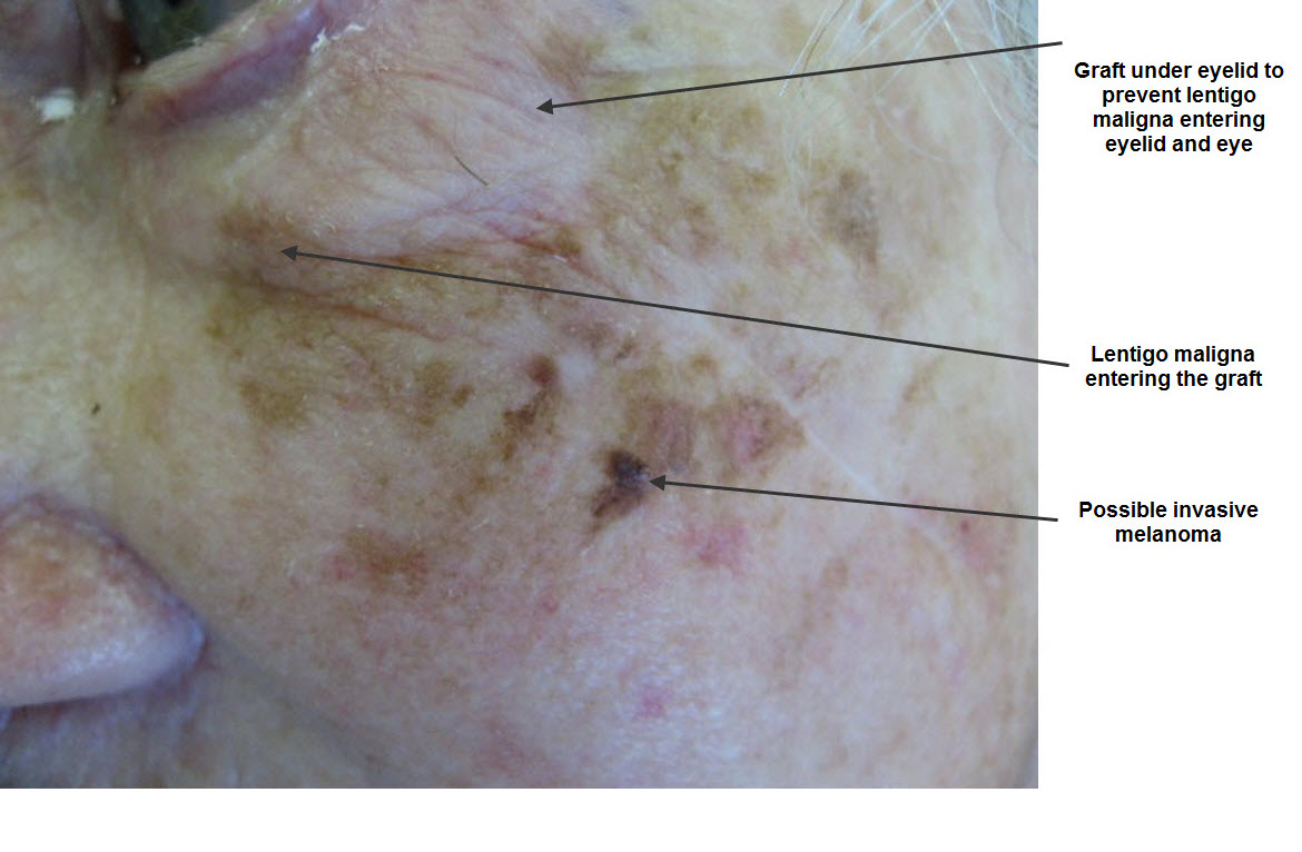 Dermoscopy Made Simple: Lentigo maligna