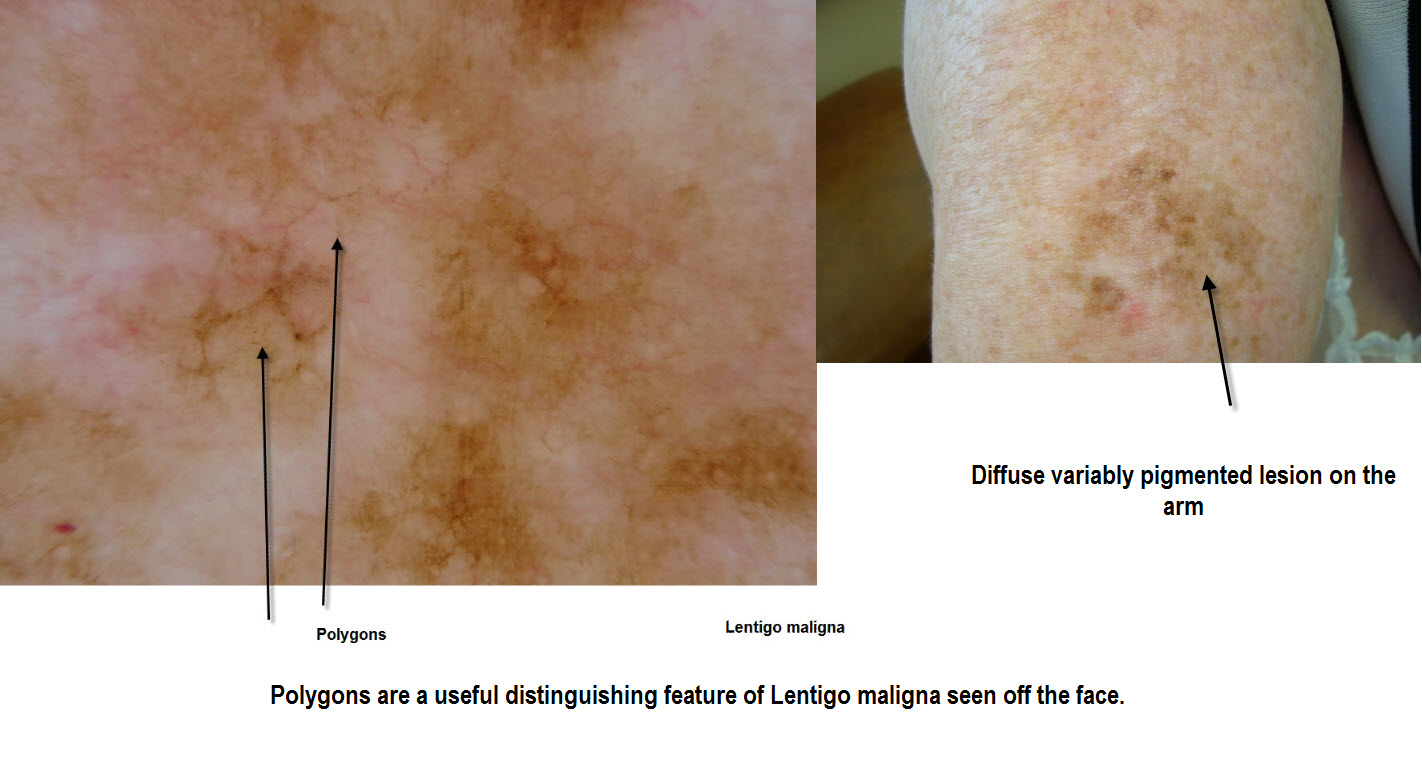 Dermoscopy Made Simple: Lentigo maligna